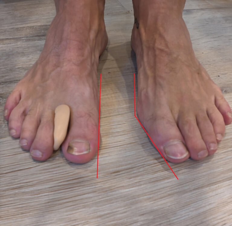 Orthoplastie et soins du pied – Podologue à Braine-l’Alleud